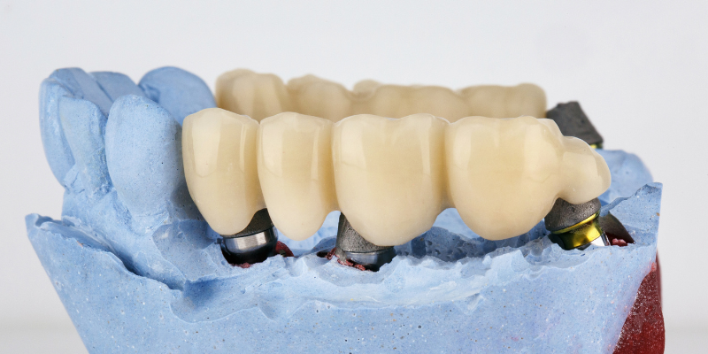 Dental Bridge Fell Out? Here's What to Do!
