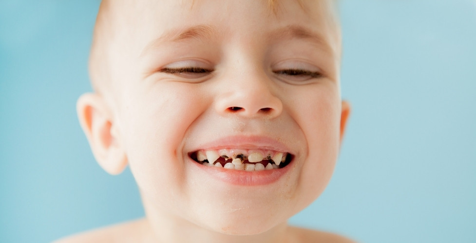 7 Steps to Stop Baby Bottle Tooth Decay for Healthy Teeth